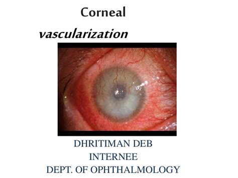 Corneal Neovascularization