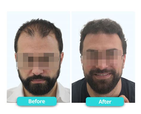 Best Hair Transplant In Dubai Tunio Aesthetics