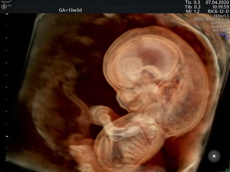 The Role Of First Trimester Ultrasound Empowered Womens Health