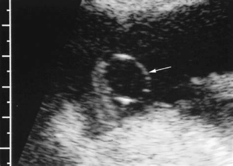 Obstetric Ultrasound Second And Third Trimester Radiology Key