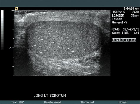 Testicular Microlithiasis Preceding Metastatic Mixed Germ Cell Tumor