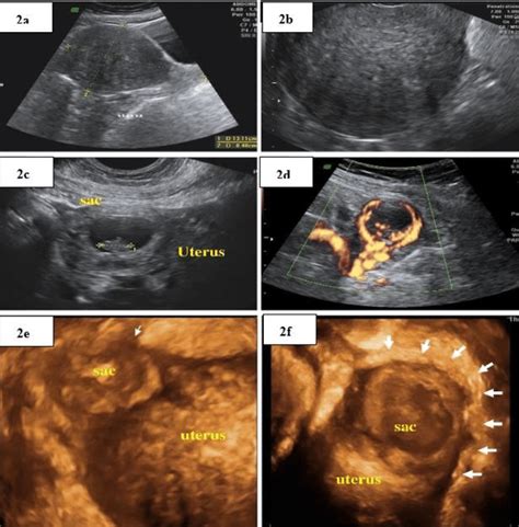 Interstitial Pregnancy Case 2 2a And 2b Transabdominal And