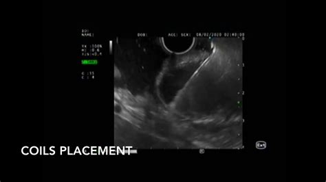 Eus Guided Gastric Varix Coiling And Glue Injection Youtube