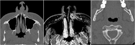 A An Axial Ct Scan Of The Paranasal Sinuses Was Obtained In 2013 And