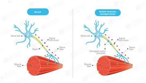 multiple sclerosis ms find the best stem cell treatment