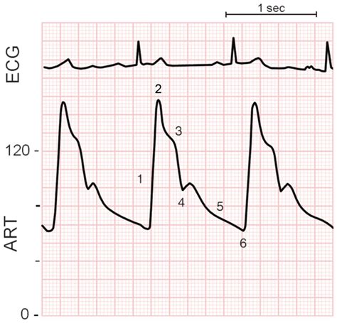 Chapter 30 Cardiovascular Monitoring Anesthesia Key