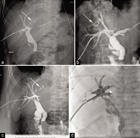 percutaneous transhepatic cholangioscopy and stone extraction in a