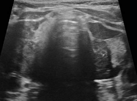 Head And Neck 4 1 Thyroid Gland Case 4 1 3 Thyroid Malignant