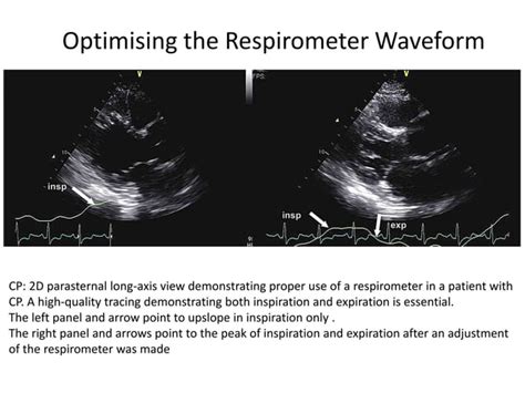 Echo Differentiation Of Restrictive Cardiomyopathy And Constrictive