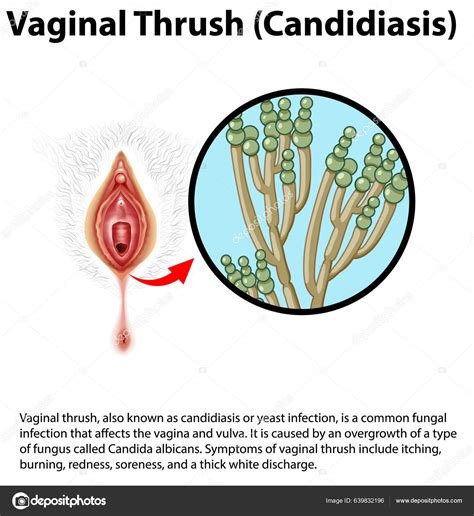 Vaginal Thrush Candidiasis Infographic Explanation Illustration Stock