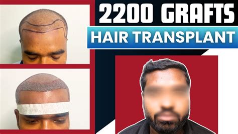 Hair Transplant Result Hairmate Clinic Delhi Pune Kolkata