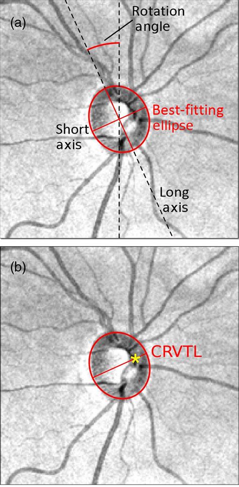illustration of a ellipse fitting around onh and b the crvtl on the
