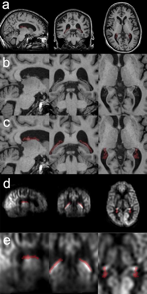 Choroid Plexus Regions Segmented Based On T1 Weighted Images The