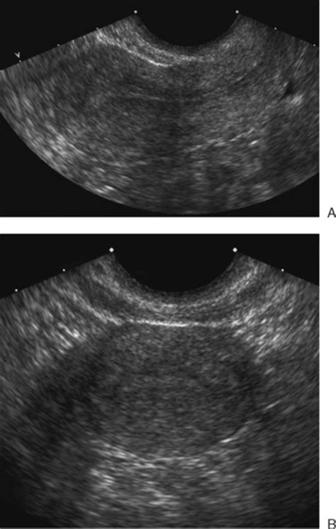 Ultrasound Evaluation Of The Uterus Radiology Key