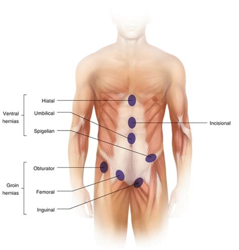 About Hernias Hernia Surgery Suny Upstate Medical University