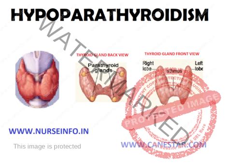 Hypoparathyroidism Nurse Info