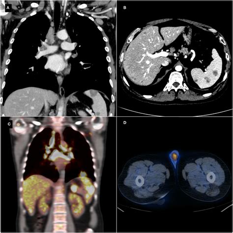 Thoraco Abdominal Contrast Enhanced Computed Tomography Ct Scan