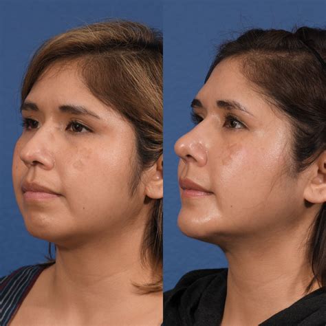 Rhinoplasty And Chin Before And After 1