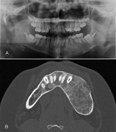 Central Giant Cell Granuloma Radiographic Features