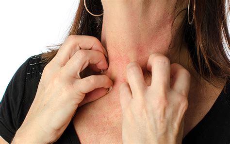 Stress Rash Causes Symptoms Treatments And Tips Skinkraft