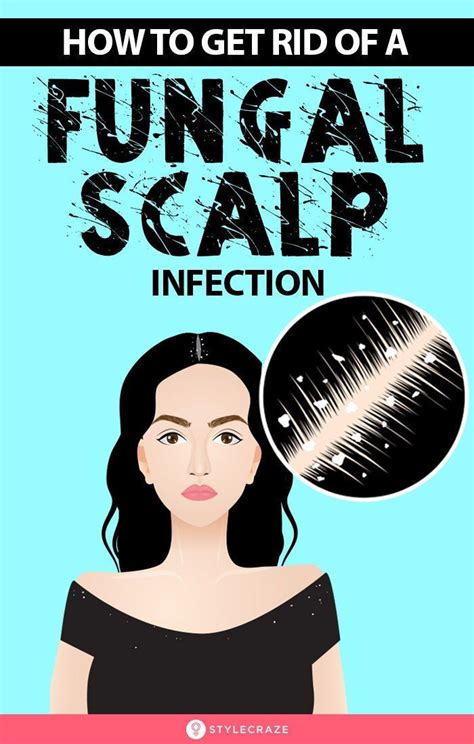 7 Home Remedies To Get Rid Of Fungal Scalp Infection Home Remedies