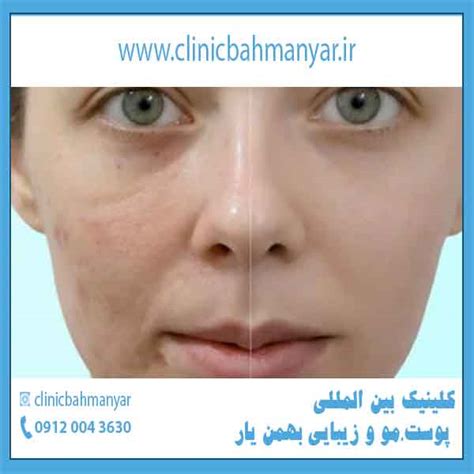 بهترین راهکارهای از بین بردن جای جوش و درمان آکنه کلینیک تخصصی پوست و