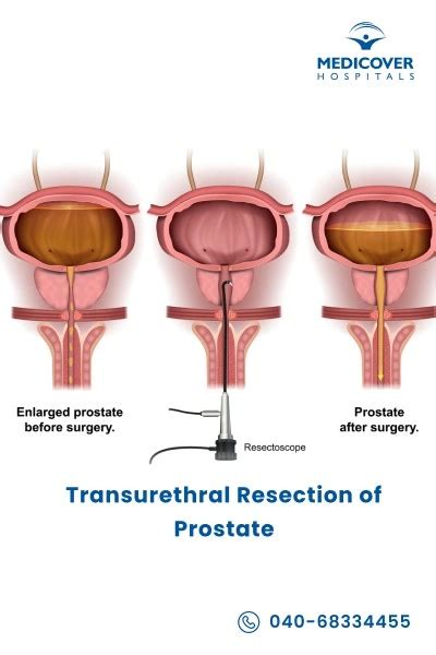 Image result for Transurethral Resection Procedure