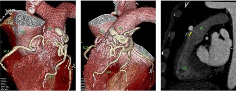 Image result for Normal Coronary CT Angiogram