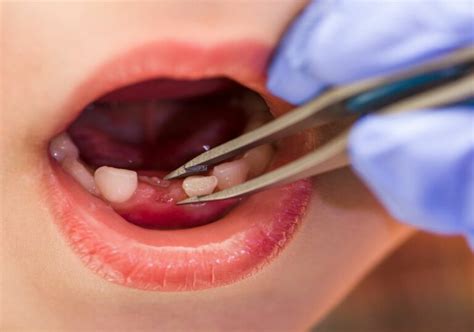 Image result for Clean Teeth Pull Tooth