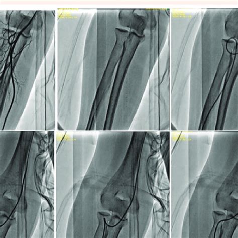 Image result for Radial Loop Angiogram