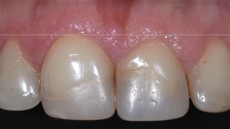 Image result for Impression Procedure