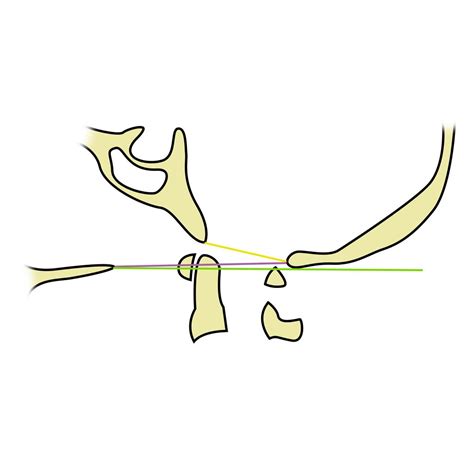 Basilar invagination measurements | Radiology Case | Radiopaedia.org ...