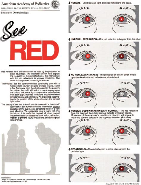 Image result for Red Reflex