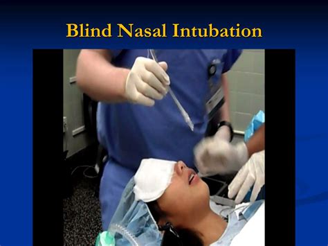 Image result for Non-Invasive Intubation