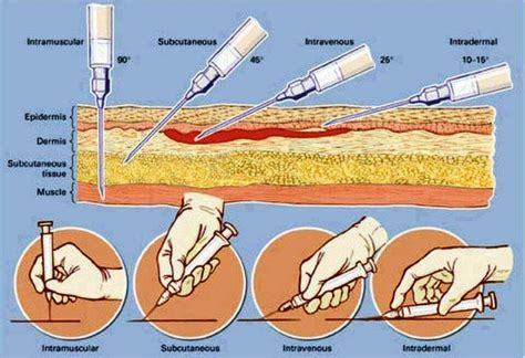 Intramuscular Injection
