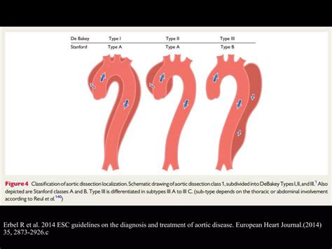 Image result for Type 2 Aortic Dissection