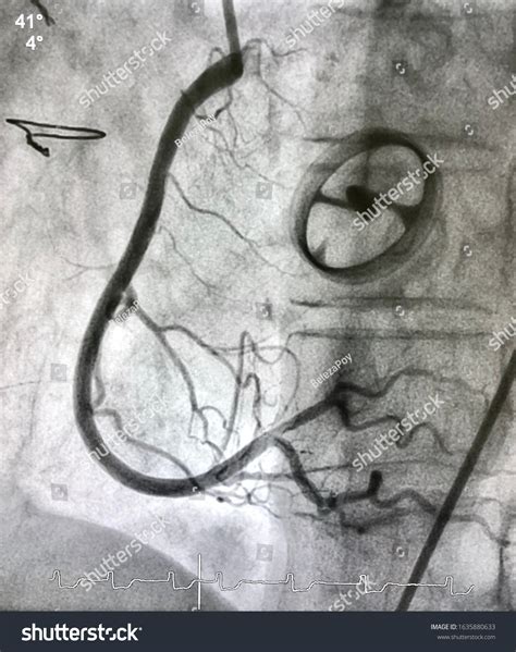 Image result for Normal Coronary Angiogram