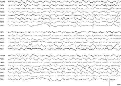 Image result for Urogram Triphasic