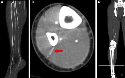 Image result for Left Lower Extremity Angiogram