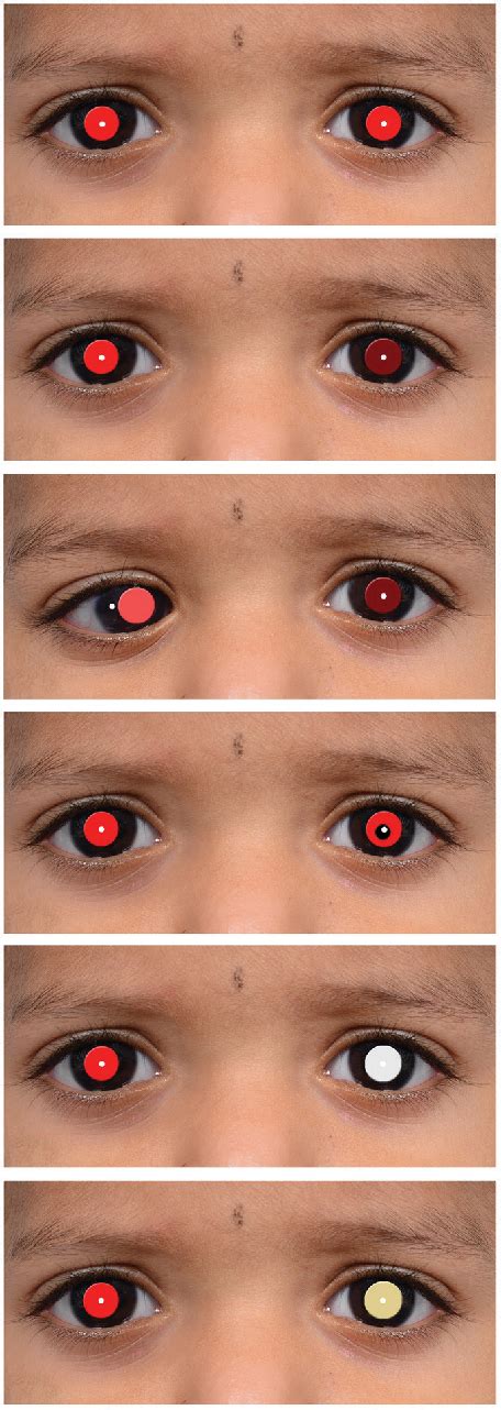 Image result for Red Reflex