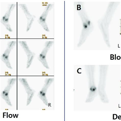 Image result for Triple Phase Bone Scan