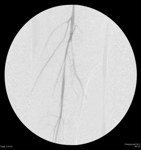 Image result for Left Lower Extremity Angiogram