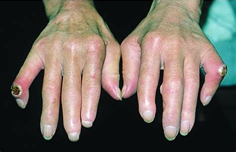 Image result for Scleroderma Skin