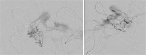 Image result for Embolization Procedure AVM