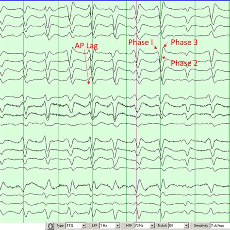 Image result for Urogram Triphasic