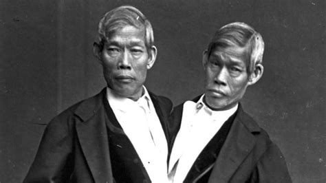 Image result for Java Island Siamese Twins