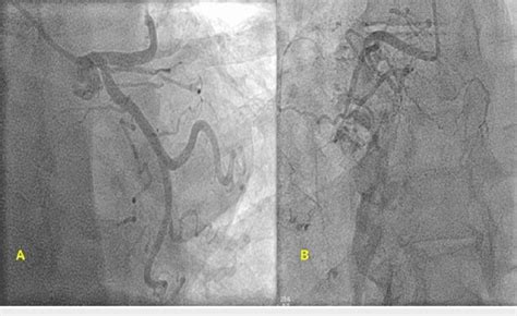 Image result for Normal Coronary Angiogram