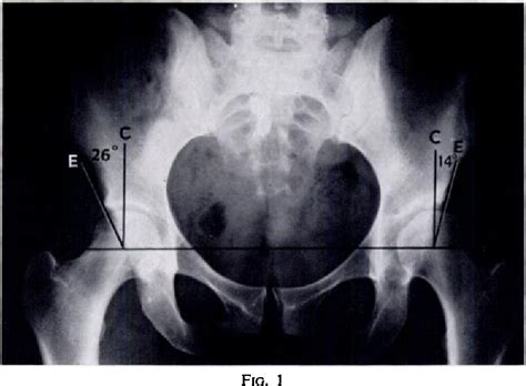 Image result for Dislocation Mutagenesis