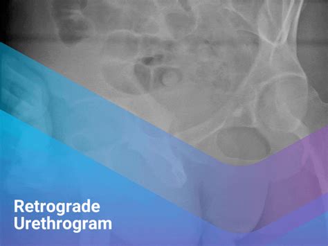 Image result for Urethrogram Procedure