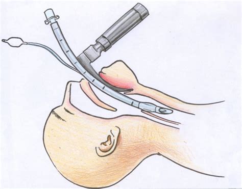 Image result for Intubation Real